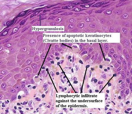 Lichen Planus Histology Civatte Body